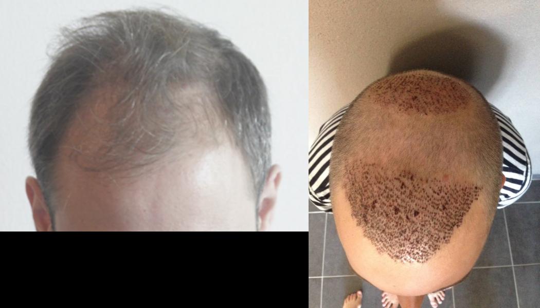 Greffe de cheveux à Istanbul