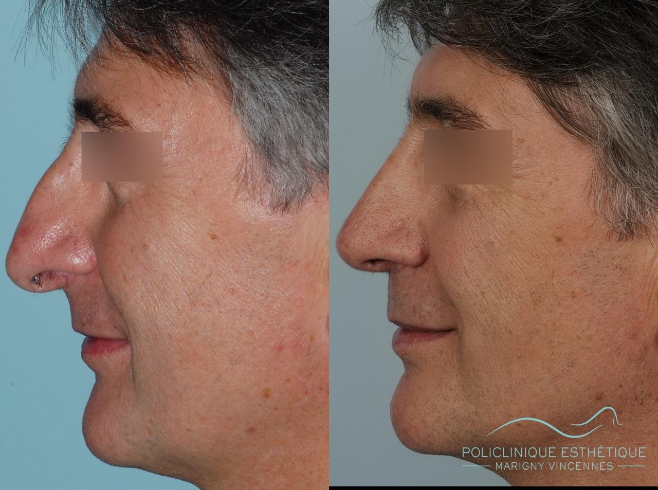 Rhinoplastie France